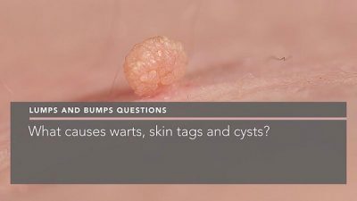 What are the best treatments for warts, skin tags and cysts? - Penelope ...